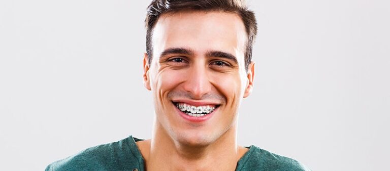 Metal Braces, All info and costs about this orthodontic procedure